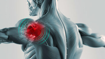 How to Fix Shoulder Impingement